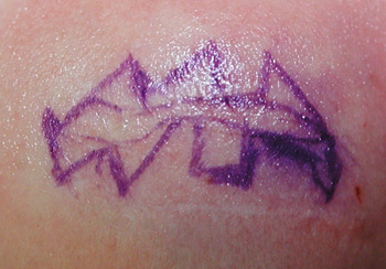 Scar Removal Surgery - Scar Revision Surgeon | Dr. Barry Eppley