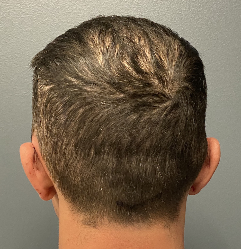 Forehead Brow Bone and Temporal Contouring - Plastic Surgeon | Dr ...