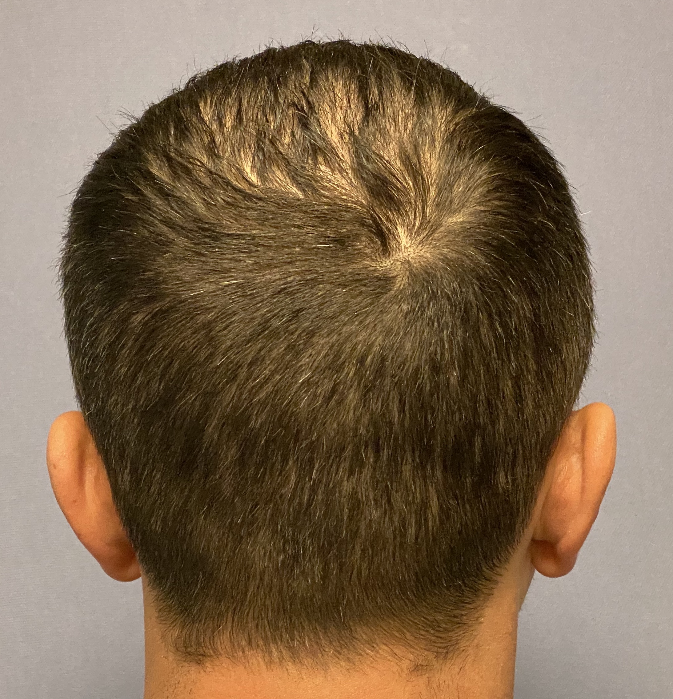 Forehead Brow Bone and Temporal Contouring - Plastic Surgeon | Dr ...