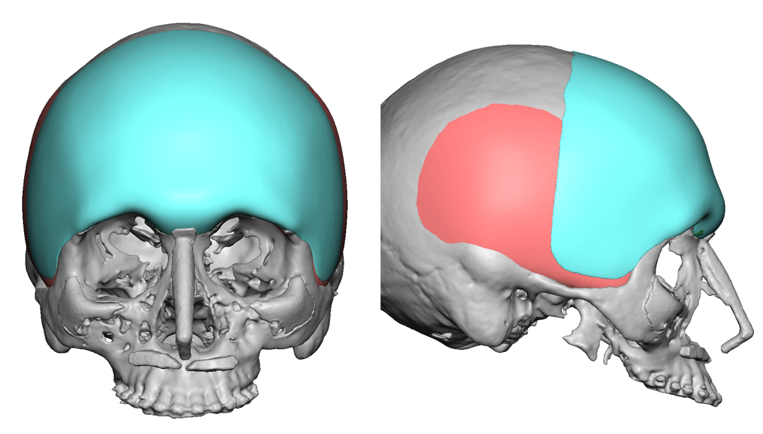 How Can A Custom Skull Implant Be Designed To Include The Forehead ...
