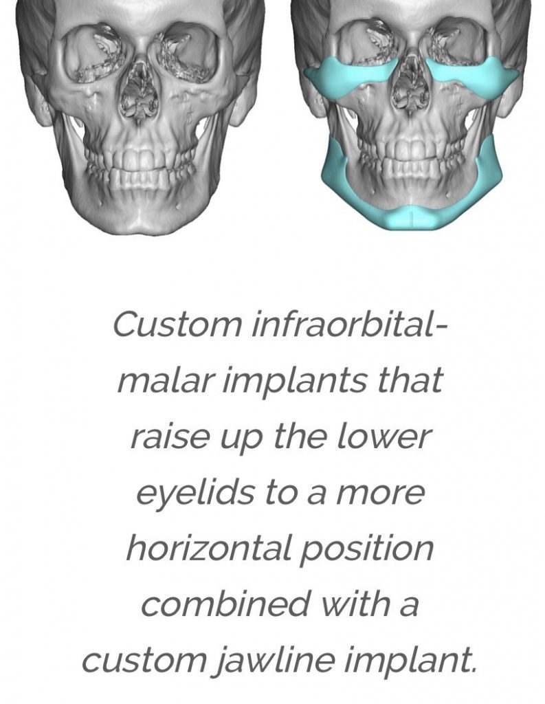 Can A Custom Infraorbital-Malar Implant Be Design To Avoid Adding ...