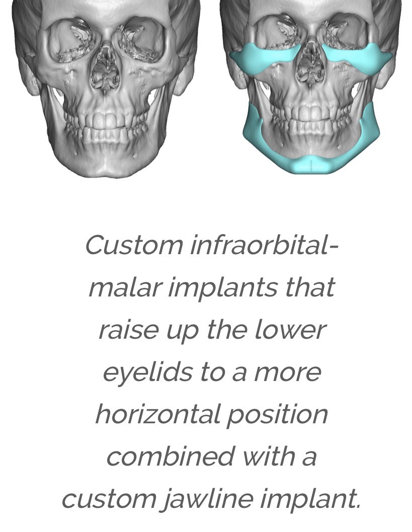 Can A Custom Infraorbital-Malar Implant Be Design To Avoid Adding ...