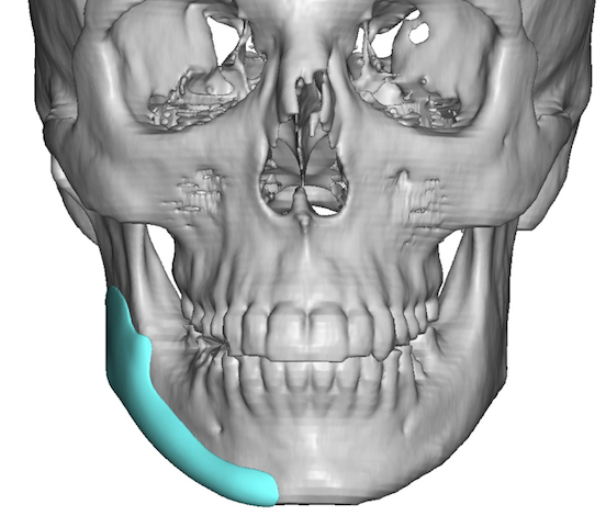 Facial Asymmetry Surgery - Top Facial Cosmetic Surgeon