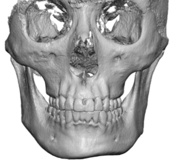 Facial Asymmetry Surgery - Top Facial Cosmetic Surgeon