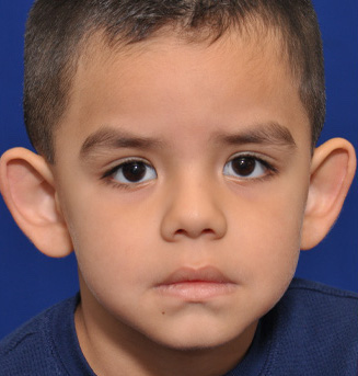 Cosmetic Ear Surgery - Top Otoplasty Surgeon