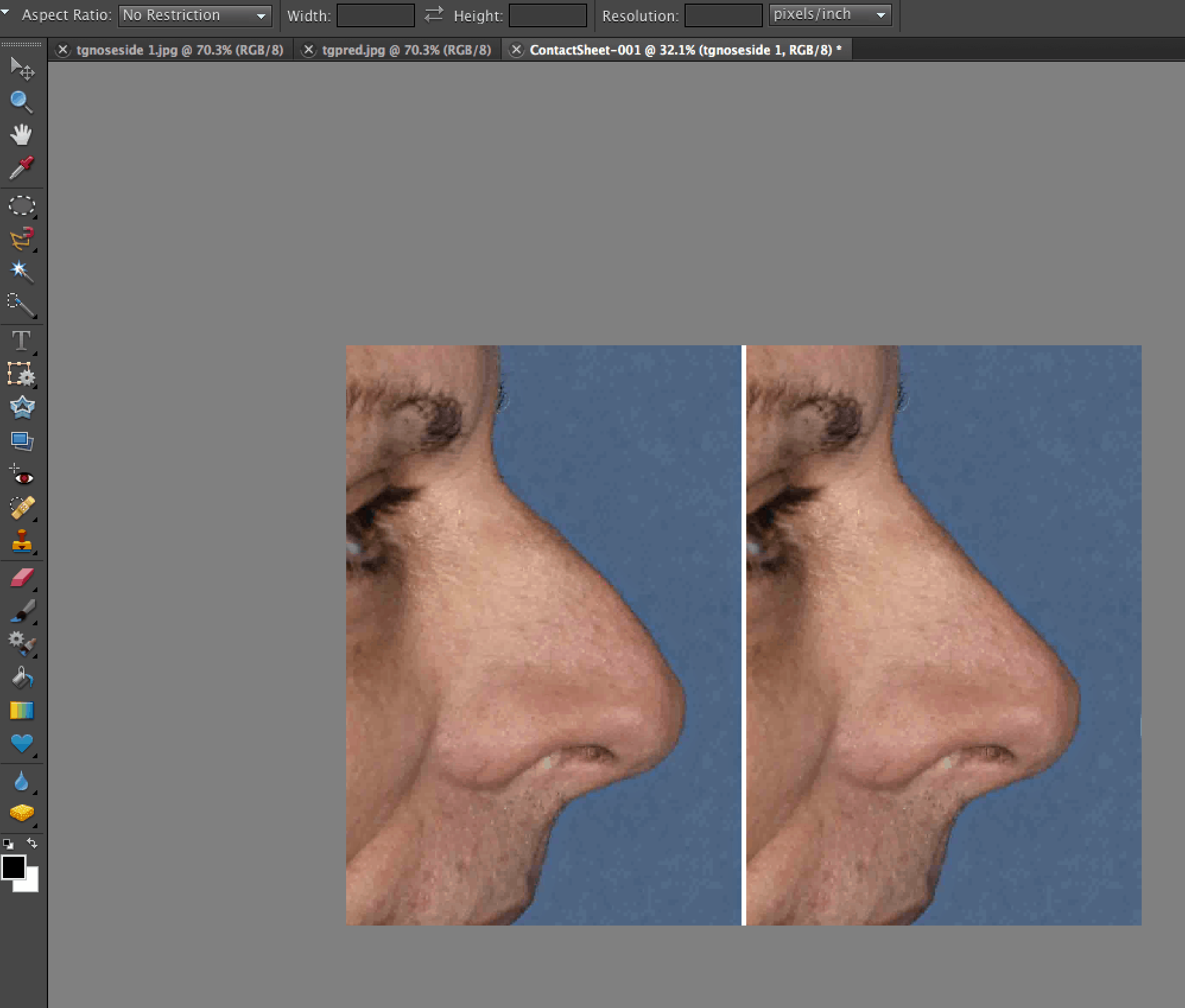 Rhinoplasty Surgery - Top Nose Surgeon