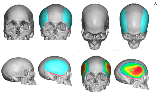 How Can I Make My Forehead And Sides Of My Head Wider? - Plastic ...