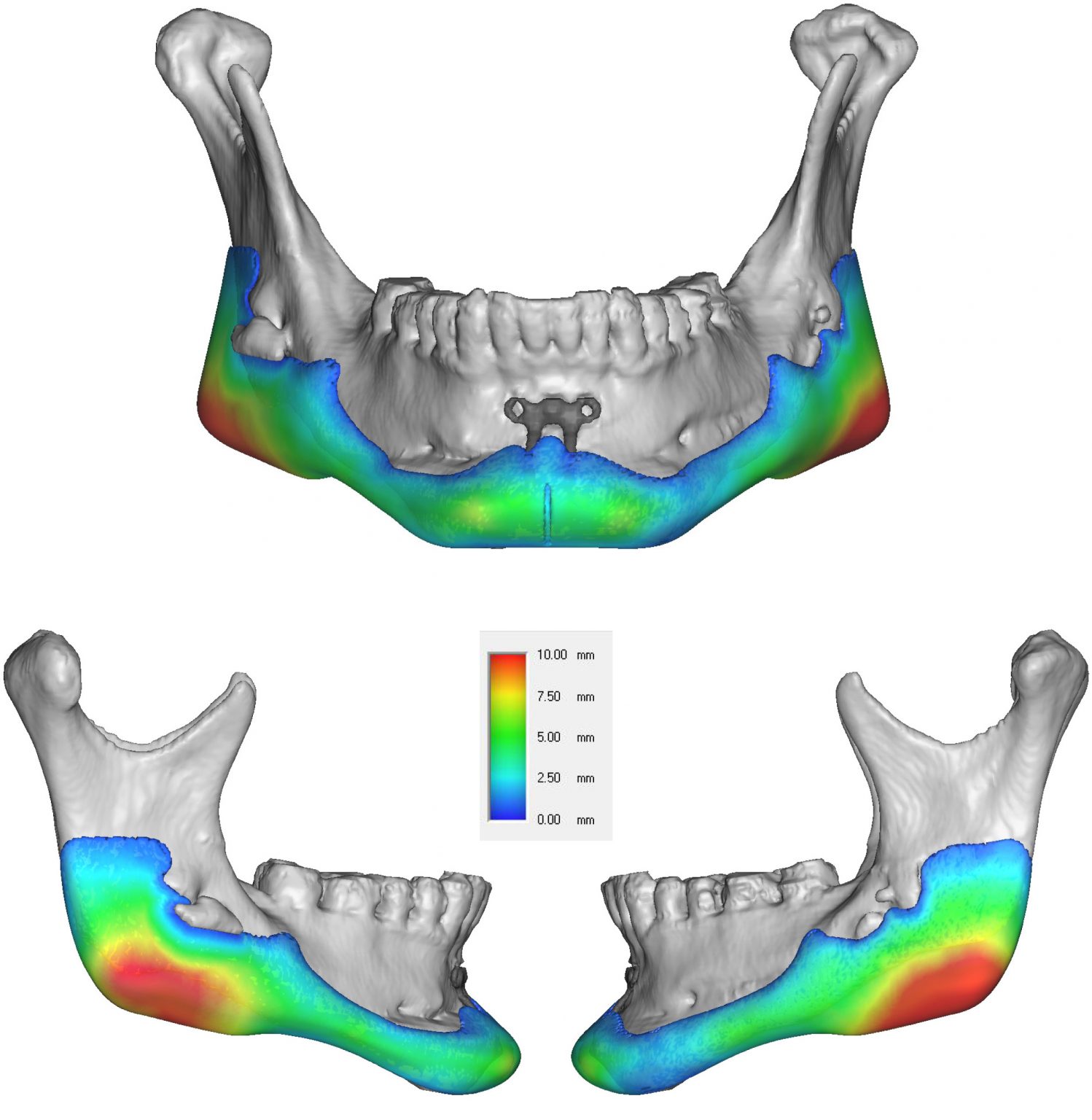 Jawline Reshaping Surgery - Jawline Enhancement