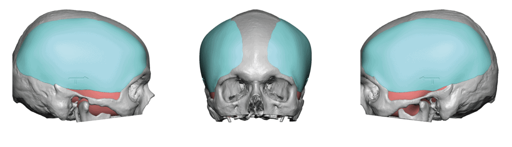 What Can Be Done So I Can Have A More Normal Head Shape? - Plastic ...