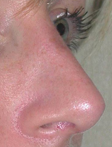Skin Atrophy Nose