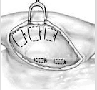 Cosmetic Ear Surgery - Top Otoplasty Surgeon