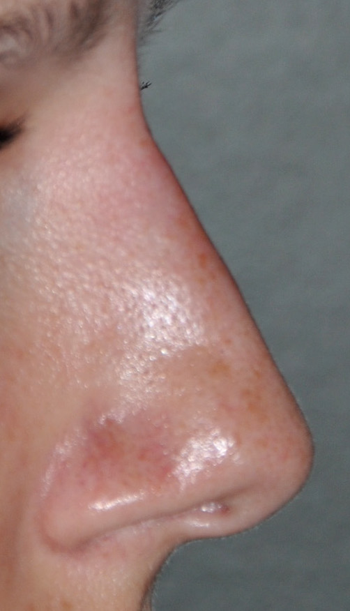 Rhinoplasty Surgery - Top Nose Surgeon