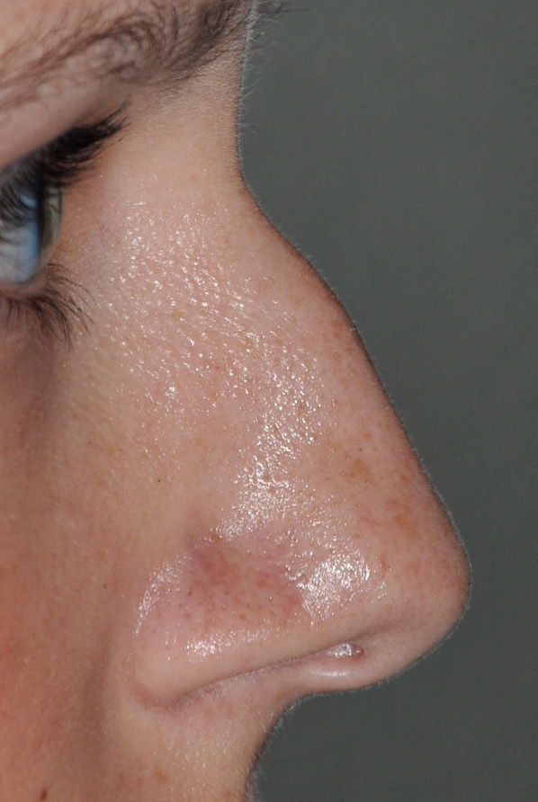 Rhinoplasty Surgery - Top Nose Surgeon
