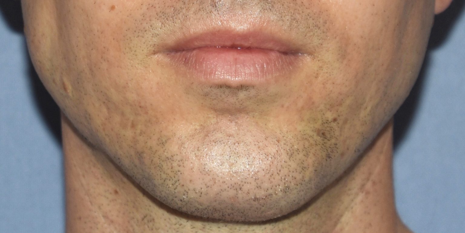 Jaw Augmentation Surgery - Jawline Enhancement Surgeon