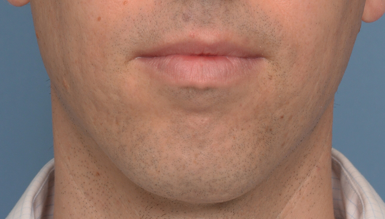 Jaw Augmentation Surgery - Jawline Enhancement Surgeon