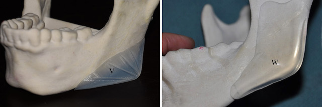 Jaw Augmentation Surgery - Jawline Enhancement Surgeon