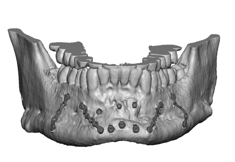 Jawline Reshaping Surgery - Jawline Enhancement