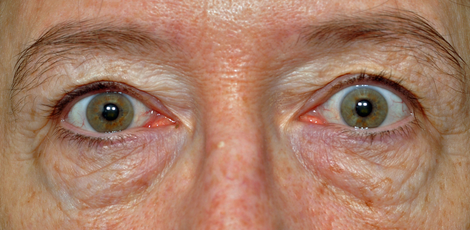 Eyelid Lift Surgery - Top Blepharoplasty Surgeon