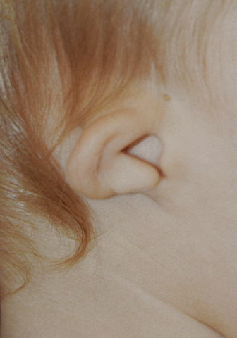 Cosmetic Ear Surgery - Top Otoplasty Surgeon