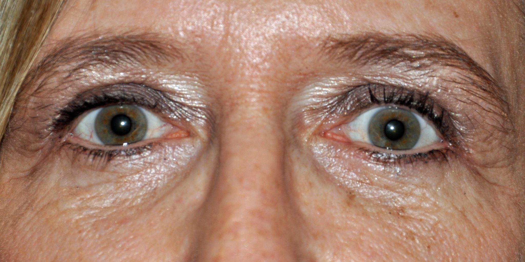 Eyelid Lift Surgery - Top Blepharoplasty Surgeon