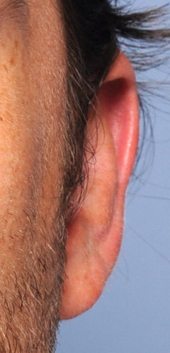 Cosmetic Ear Surgery - Top Otoplasty Surgeon
