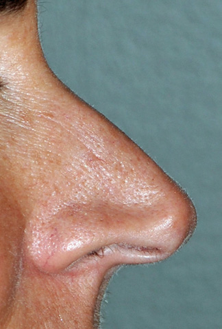 Rhinoplasty Surgery - Top Nose Surgeon