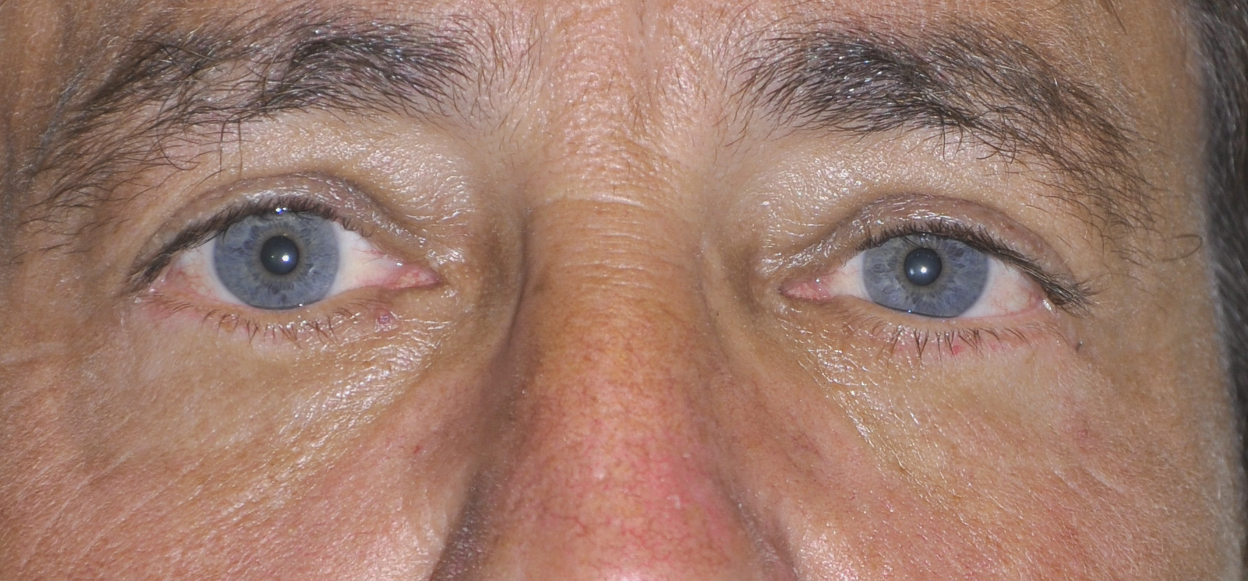 Eyelid Lift Surgery - Top Blepharoplasty Surgeon