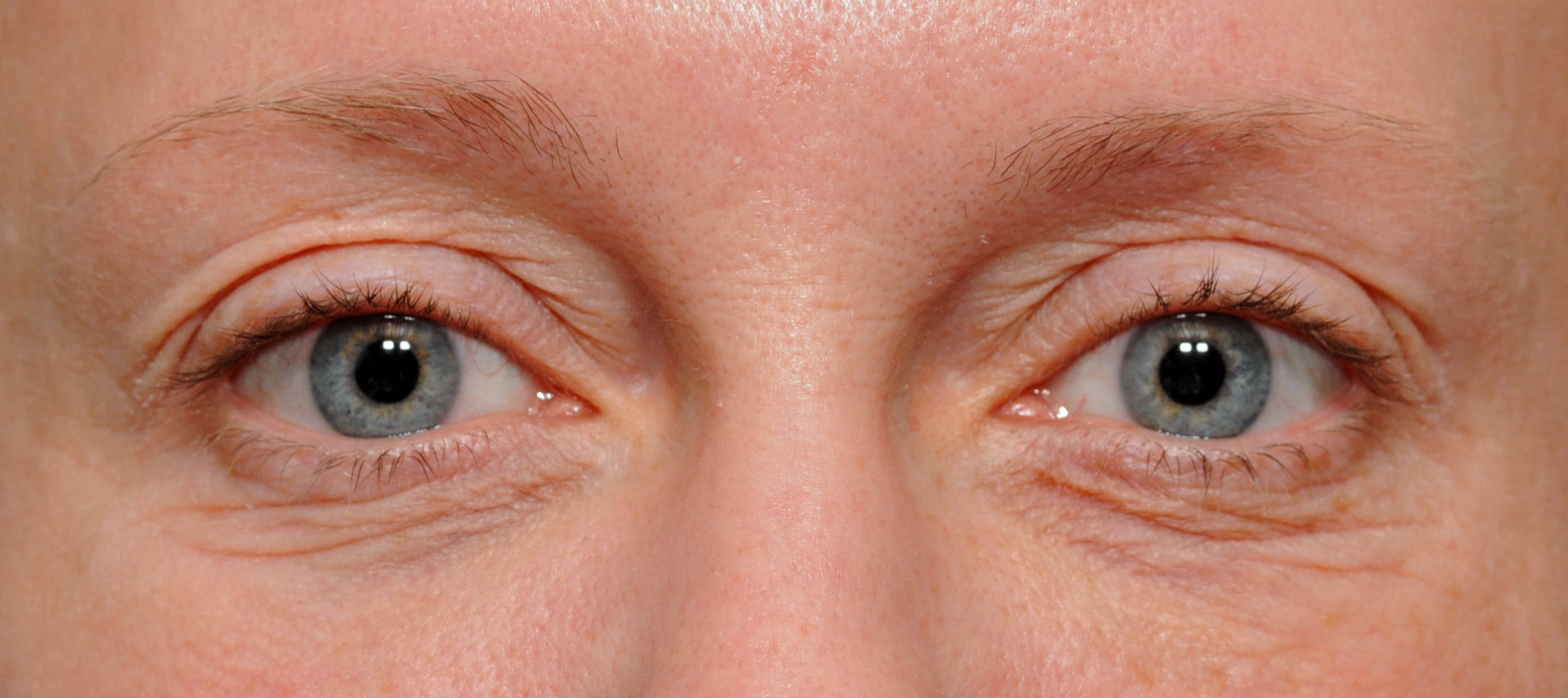Eyelid Lift Surgery - Blepharoplasty Specialist