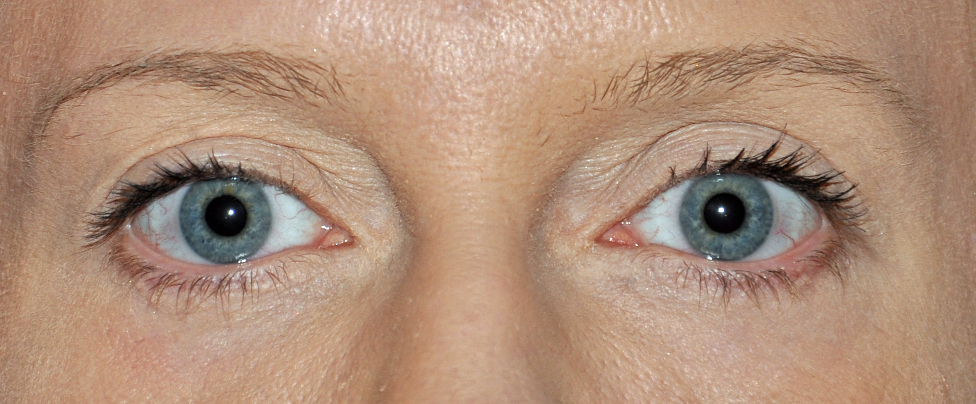 Eyelid Lift Surgery - Top Blepharoplasty Surgeon