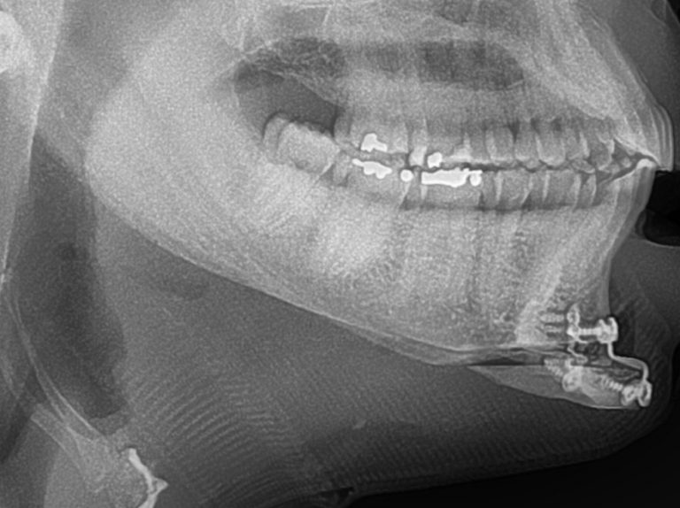 Jaw Augmentation Surgery - Jawline Enhancement Surgeon | Dr. Eppley