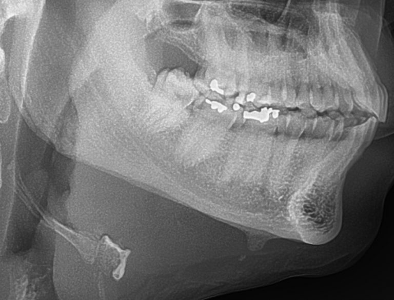 Jaw Augmentation Surgery - Jawline Enhancement Surgeon