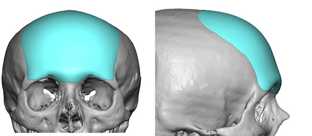 Brow Bone/Forehead Reduction Sugeon