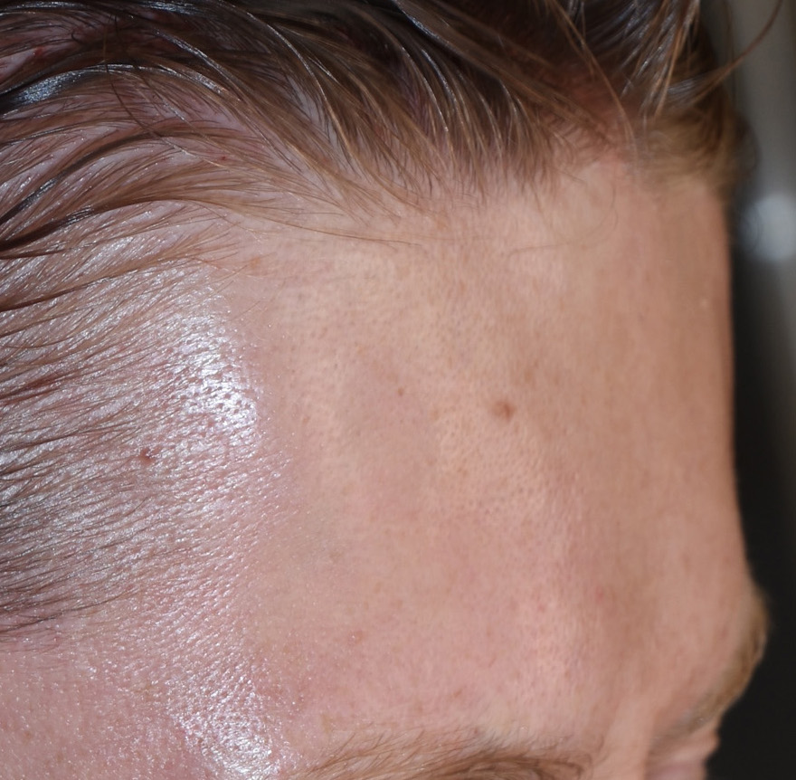 Brow Bone/Forehead Reduction Sugeon