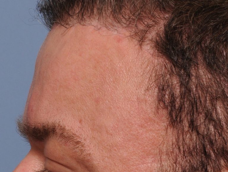 Brow Bone/Forehead Reduction Sugeon