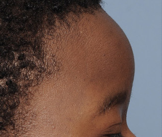 Brow Bone/Forehead Reduction Sugeon