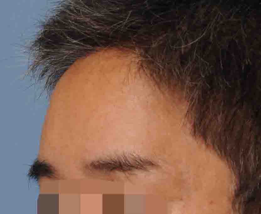 Brow Bone/Forehead Reduction Sugeon