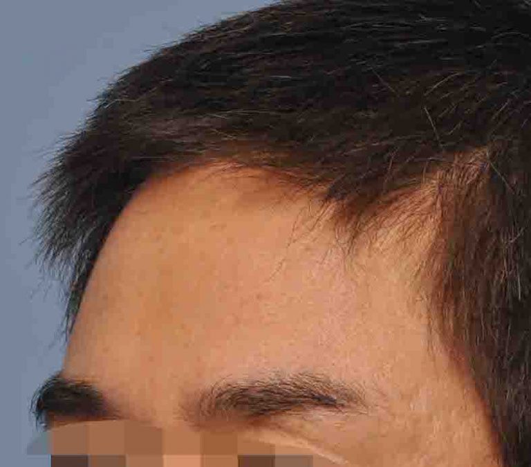 Brow Bone/Forehead Reduction Sugeon