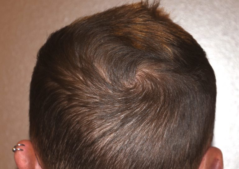 Brow Bone/Forehead Reduction Sugeon