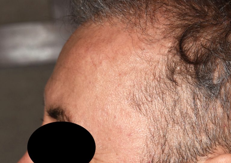 Forehead Brow Bone and Temporal Contouring
