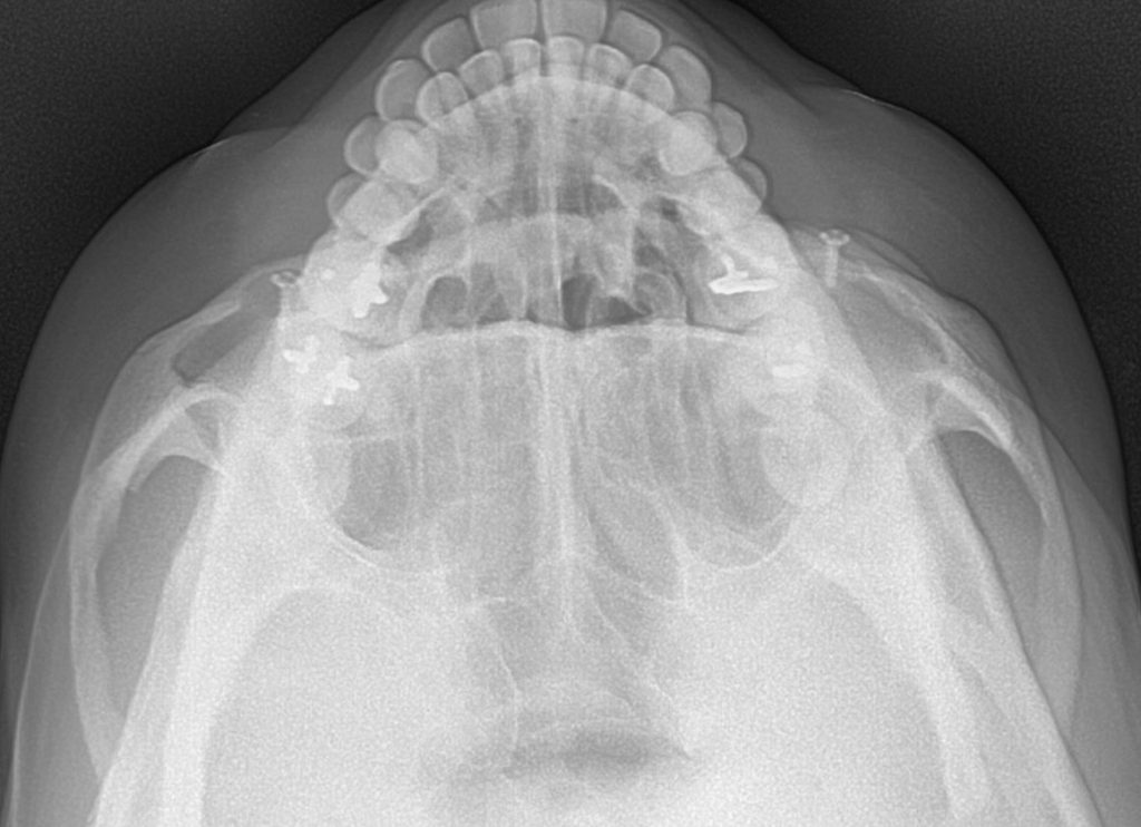 Cheek Augmentation Surgery - Cheek Implant Surgeon