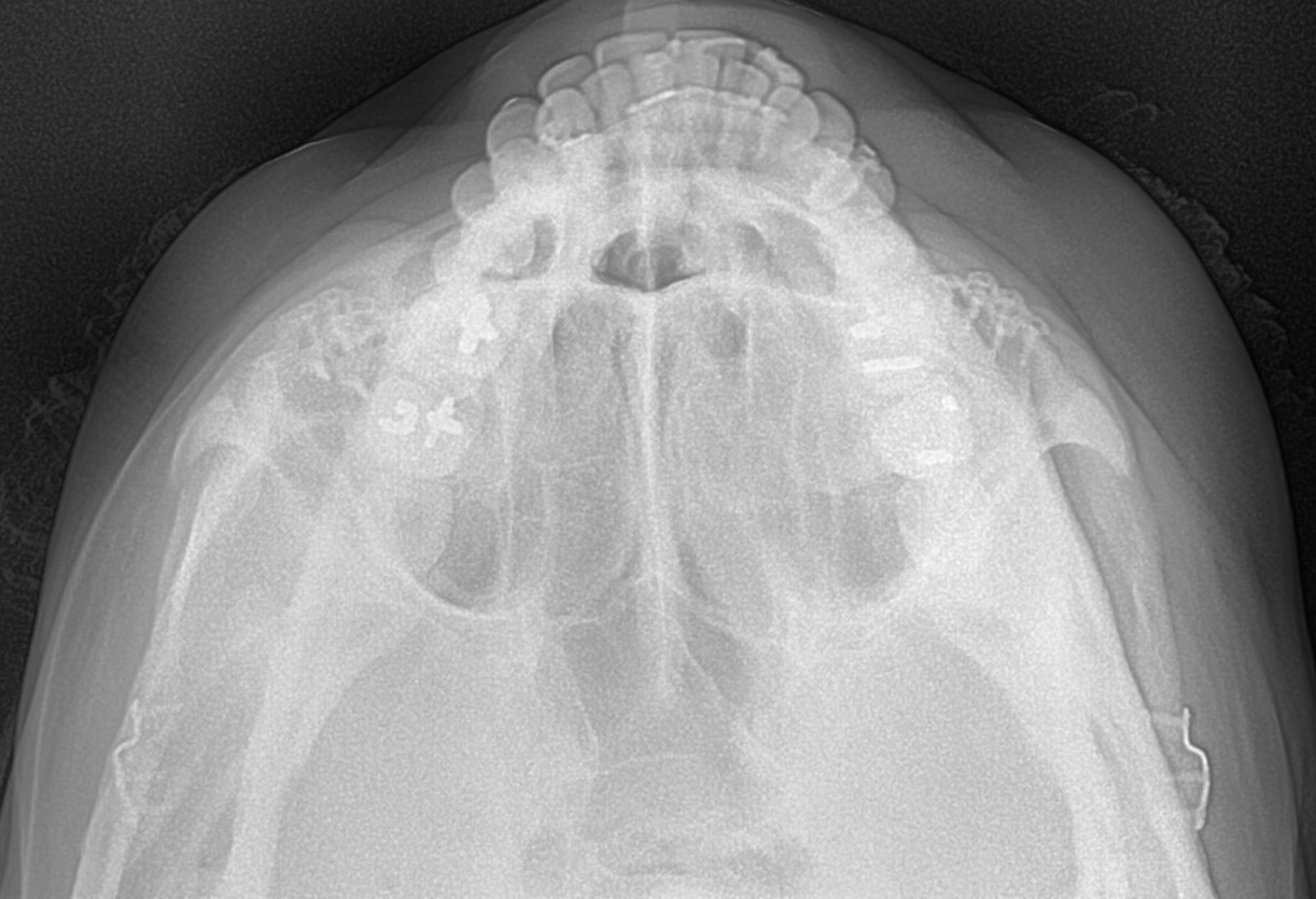 Cheek Augmentation Surgery - Cheek Implant Surgeon