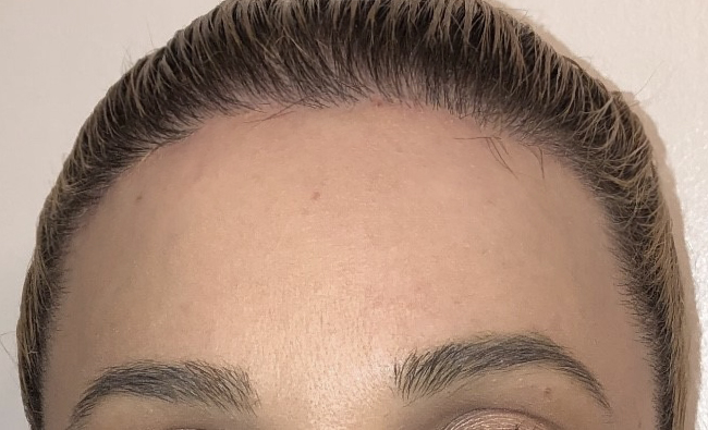 Brow Bone/Forehead Reduction Sugeon