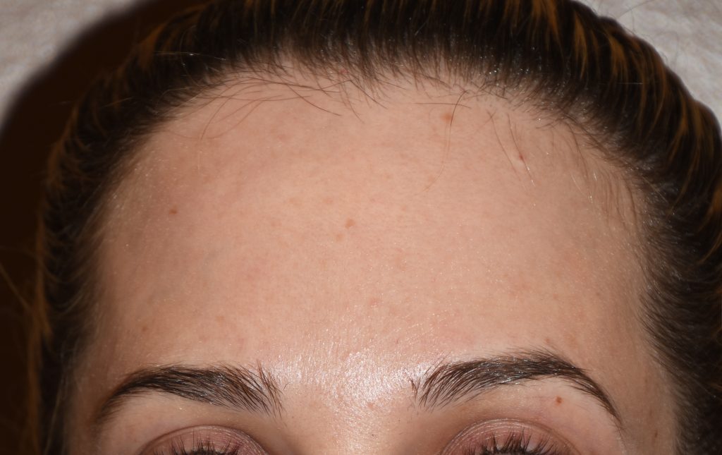 Brow Bone/Forehead Reduction Sugeon