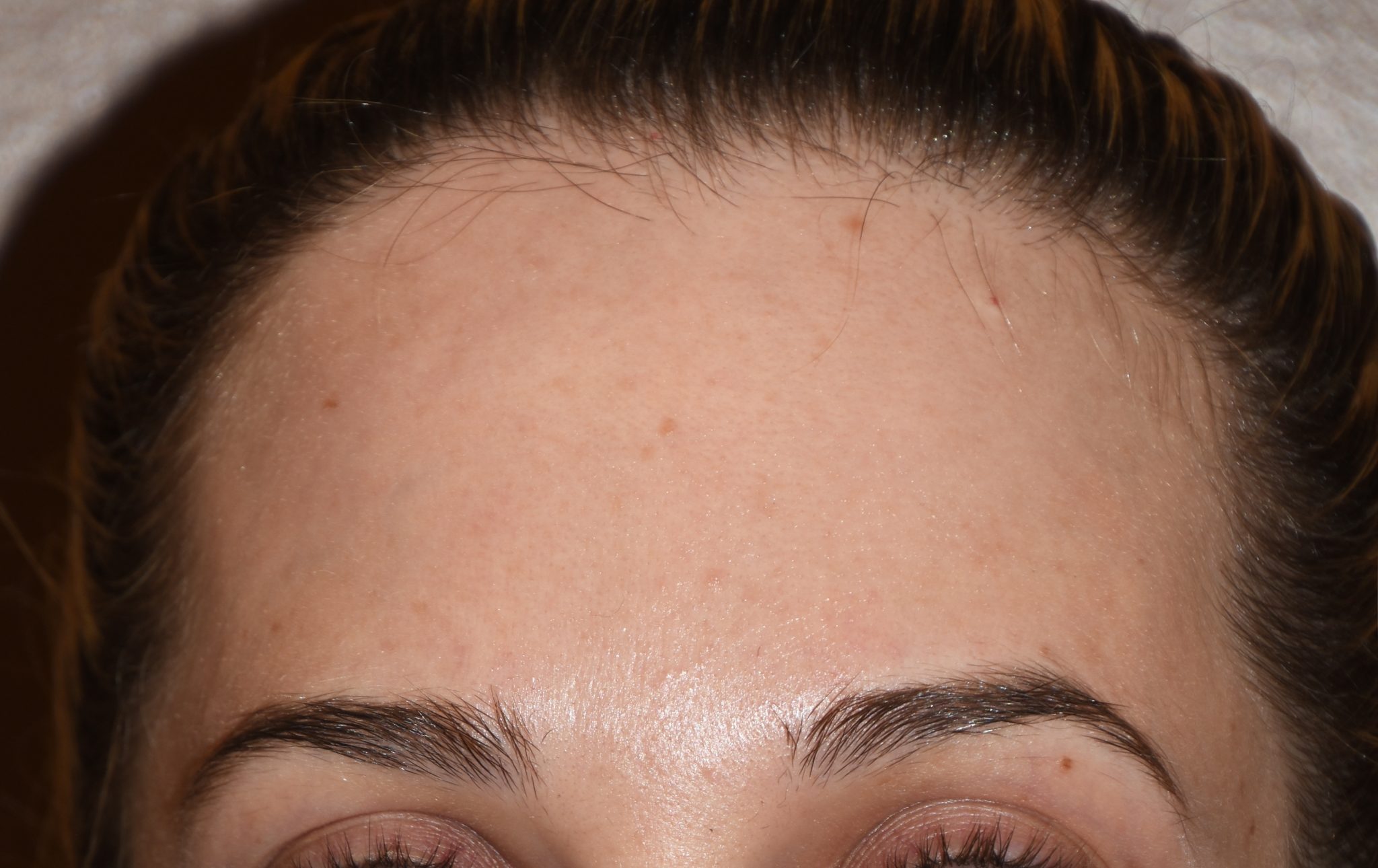 Brow Bone/Forehead Reduction Sugeon