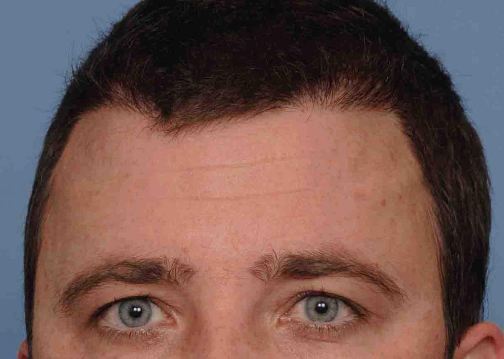 Brow Bone/Forehead Reduction Sugeon