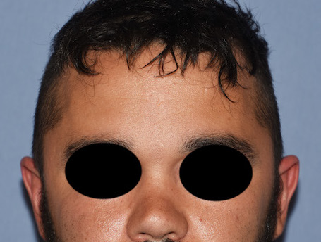 Brow Bone/Forehead Reduction Sugeon