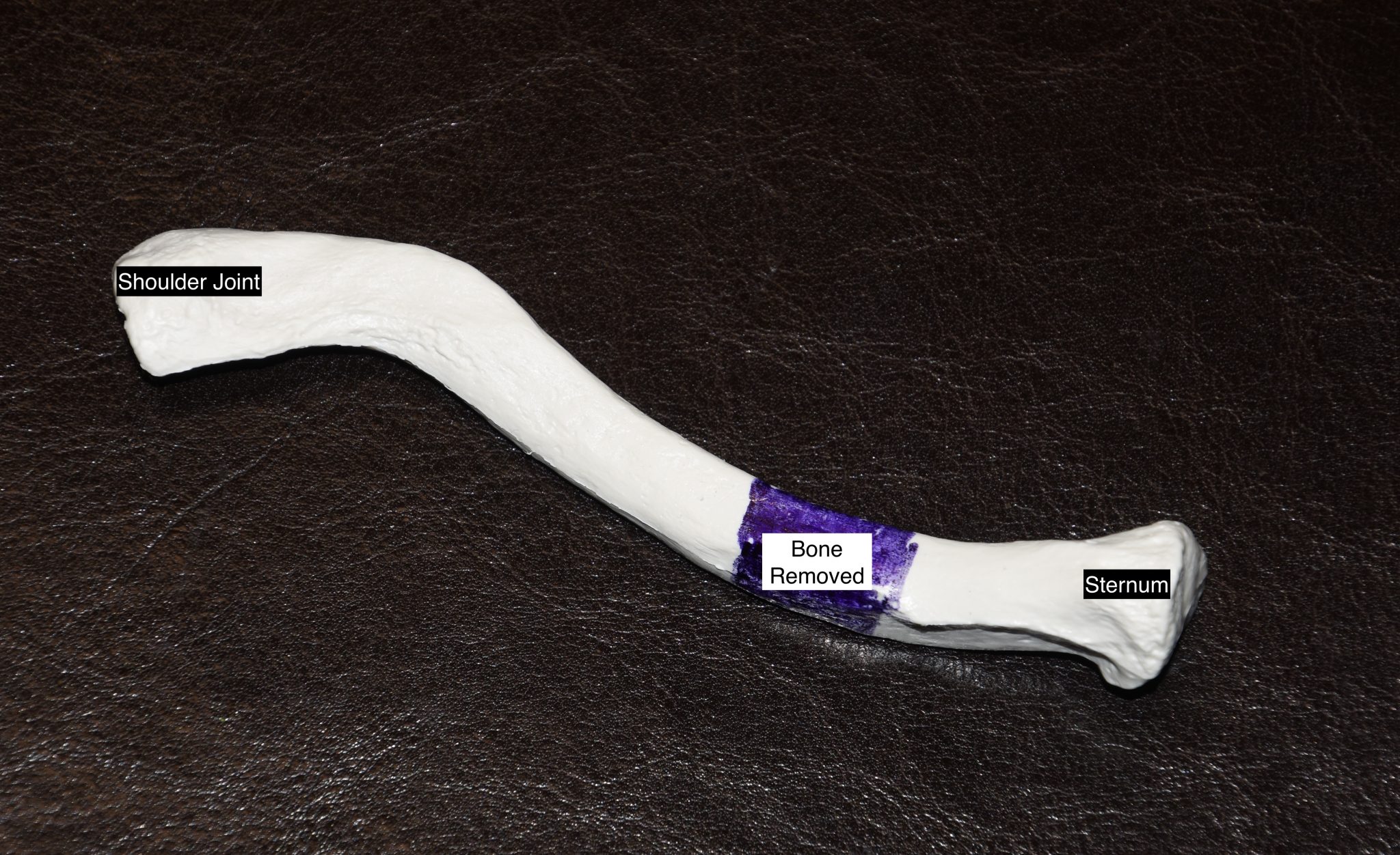 Shoulder Narrowing & Widening Surgery - Plastic Surgeon