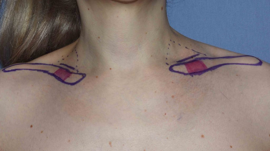 Shoulder Reshaping Surgery - Shoulder/Clavicle Reduction