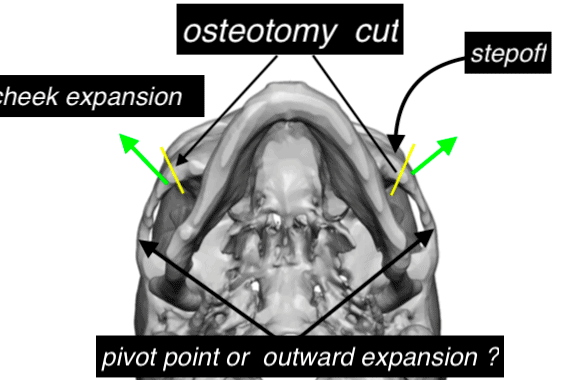 Can A Sliding Genioplasty and Zygomatic Sandwich Osteotomy Be Just As ...