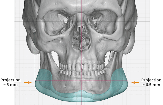 Can A Custom Jawline Implant Fix Vertical Asymmetry Of the Lower Jaw ...